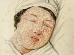 Variolation, Vaccination, and the Eradication of Smallpox – Retrospect ...